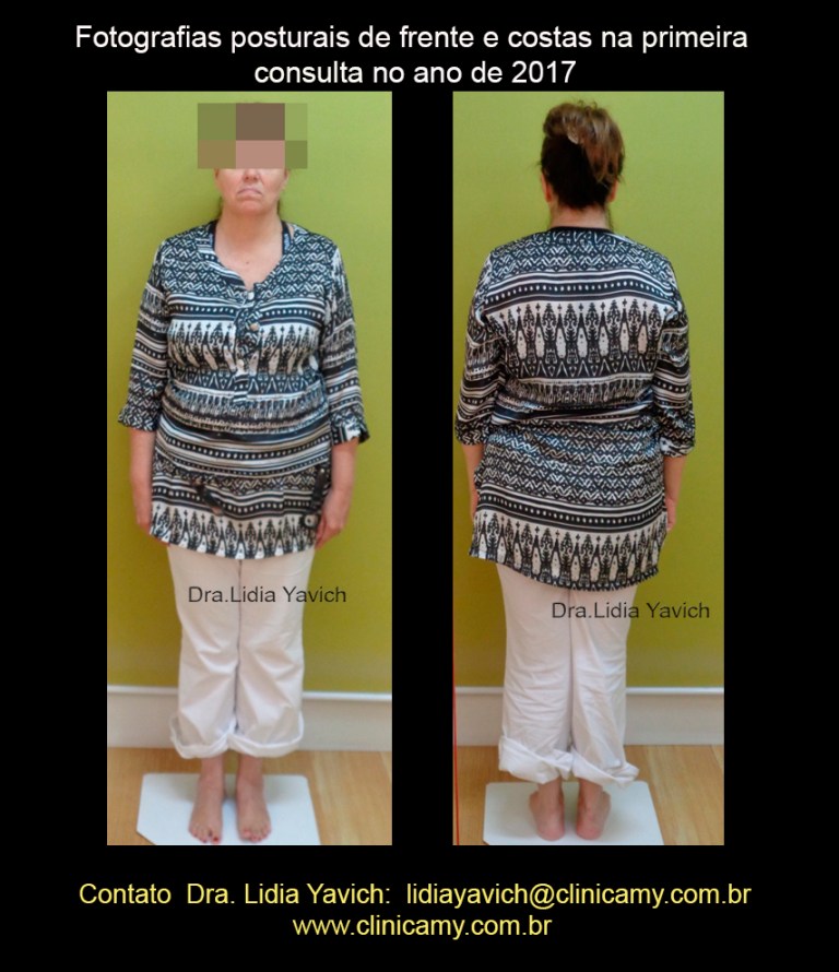 Paciente apresentando Distonia Oromandibular dois anos após a primeira ...